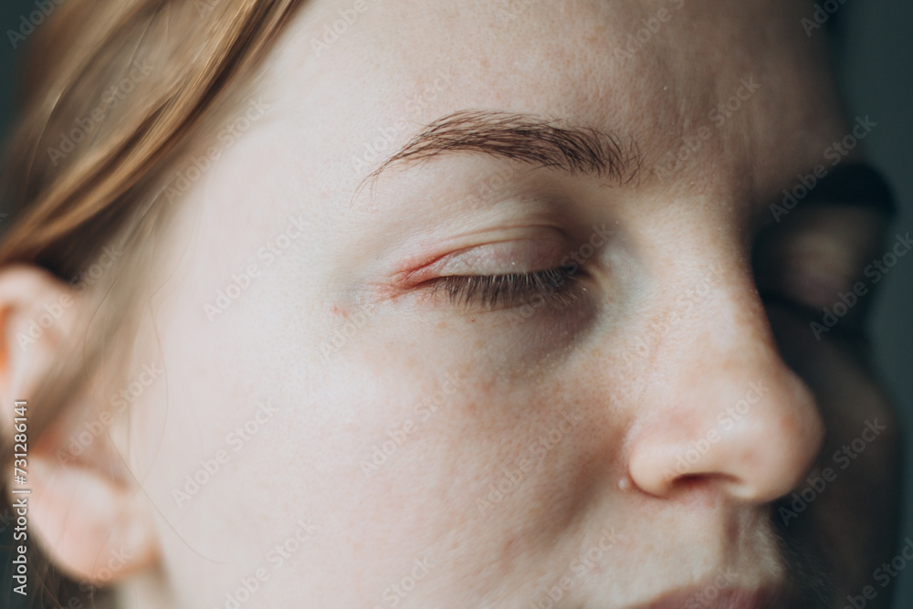 Swelling on the eyelid of the human eye. Infection on eye. Atopic ...