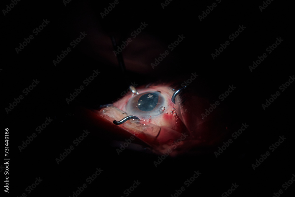 Phacoemulsification, destruction of the opaque lens by ultrasound ...