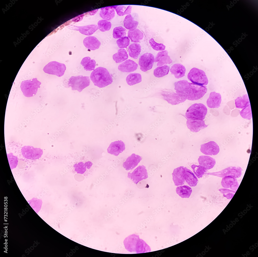 Acute myeloid leukemia (AML). Smear show shift maturation of then are ...