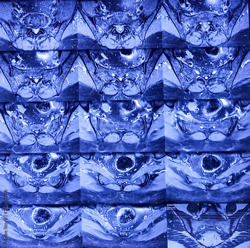 Stock-Foto „MRI of SI (Sacroiliac) joint. Screening of lumbar spine ...