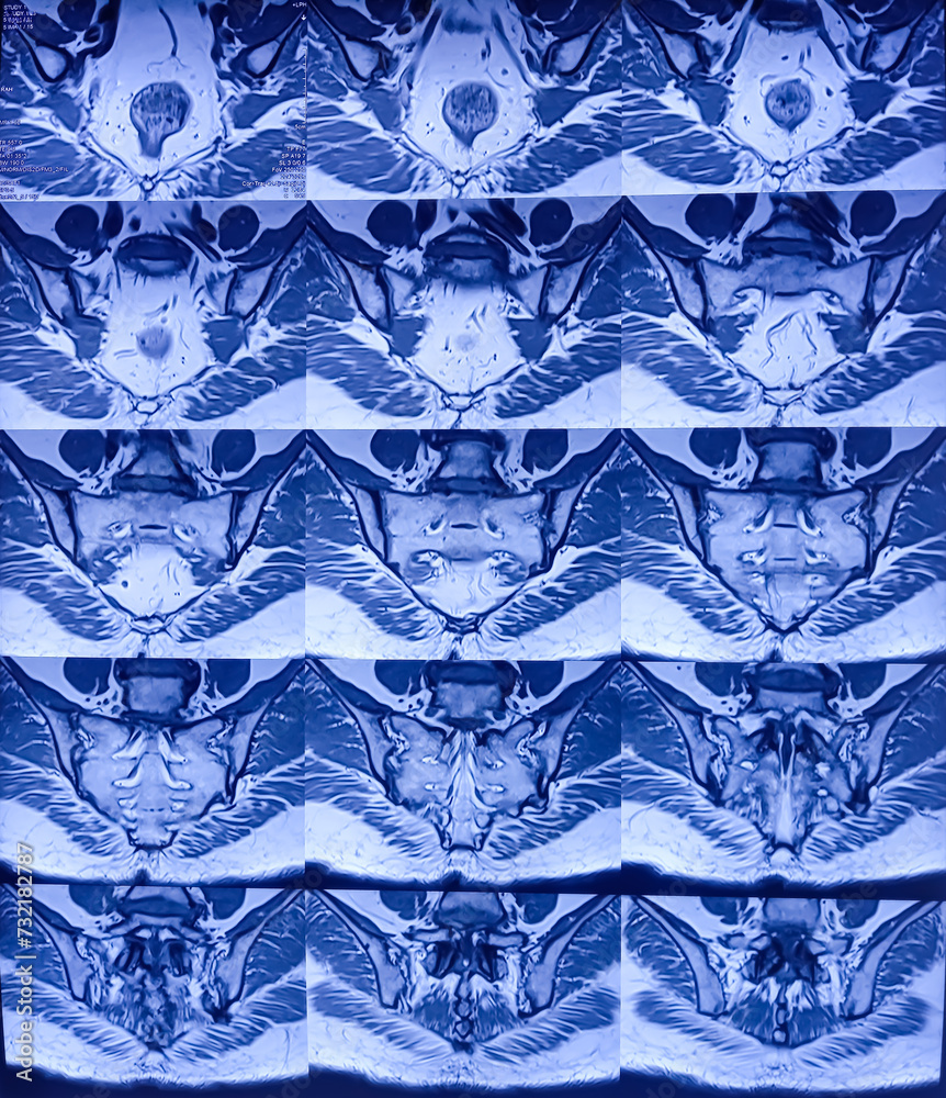 MRI of SI (Sacroiliac) joint. Screening of lumbar spine: Lumbar ...