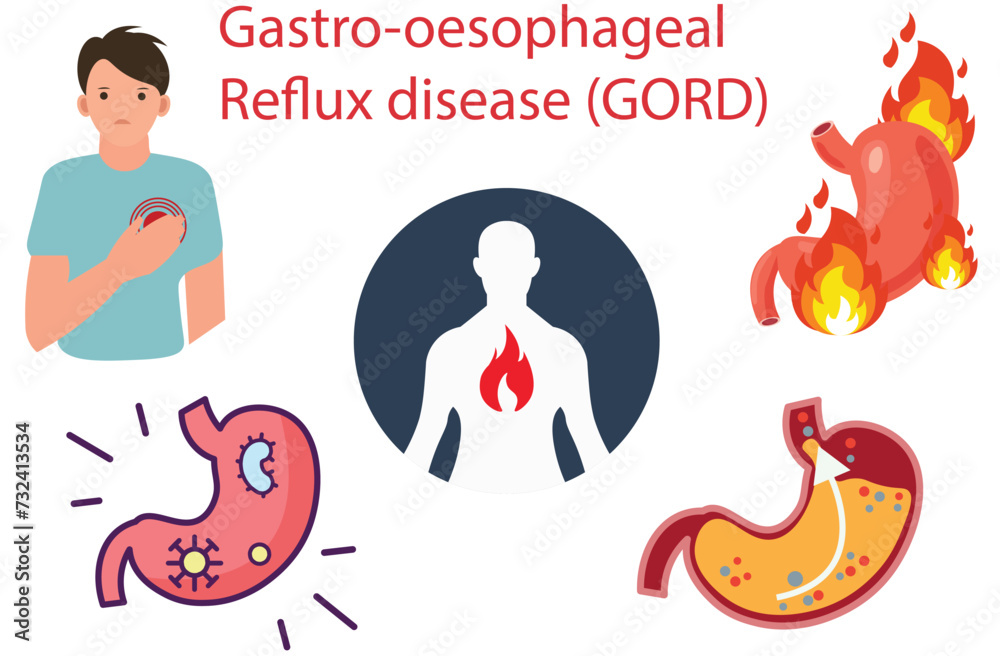 Gastro-oesophageal reflux disease (GORD),the stomach acid leak ...