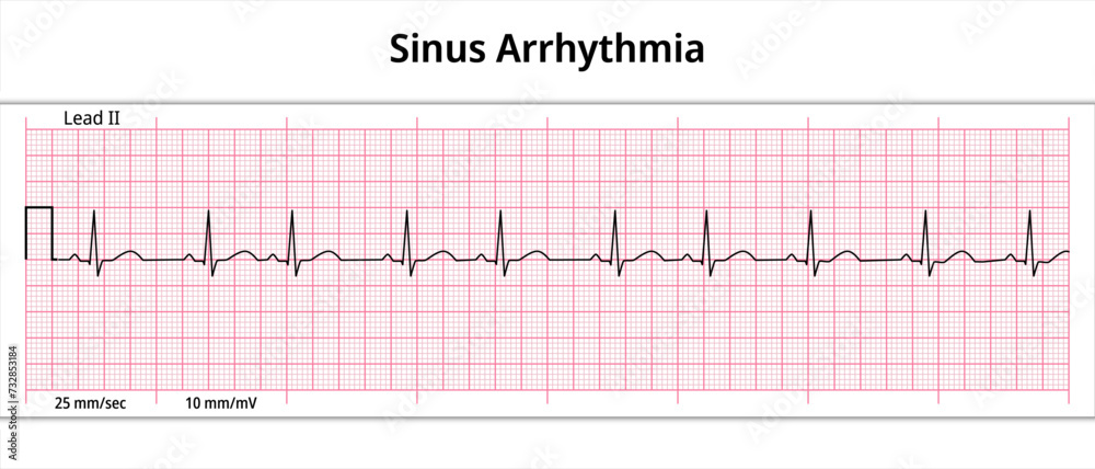 ECG Sinus Arrhythmia - 8 Second ECG Paper - Electrocardiogram Vector ...
