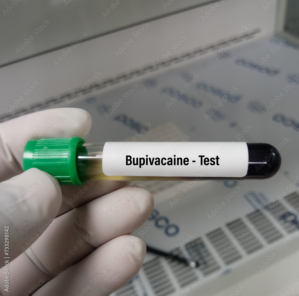 Blood sample for Bupivacaine or Marcaine blood test, It indicated for ...