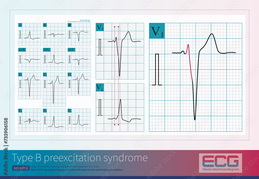 Male, 39 years old, paroxysmal palpitations for 5 years. ECG showed B ...