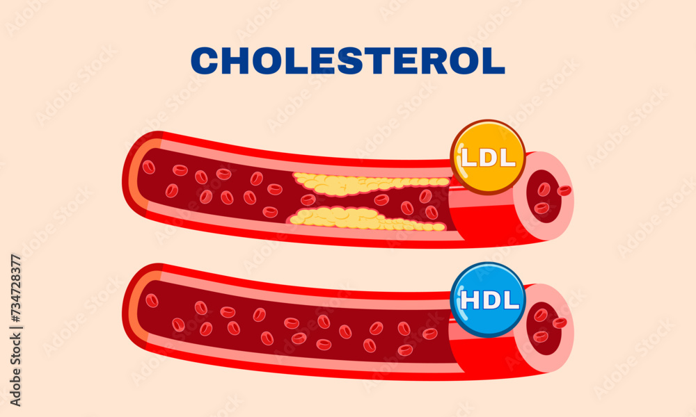 Normal blood flow, accumulation of cholesterol in blood vessels with ...