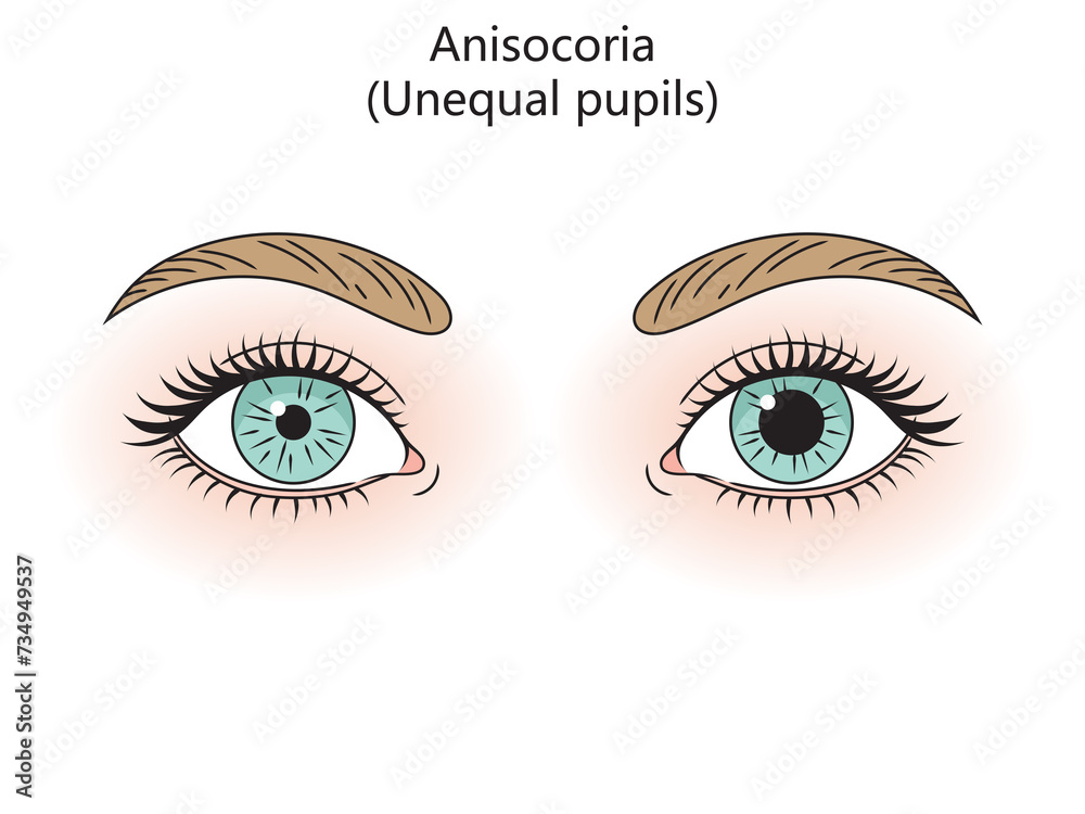 Human eyes with anisocoria diagram hand drawn schematic raster ...