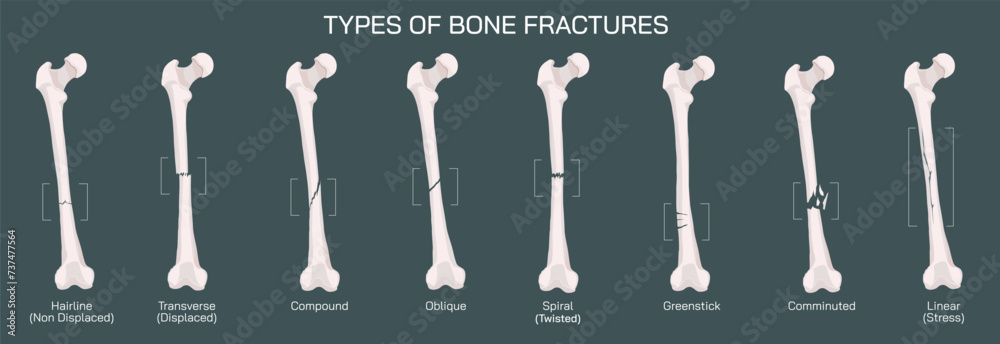 Types of bone fracture. Structure of a bone vector illustration. The ...