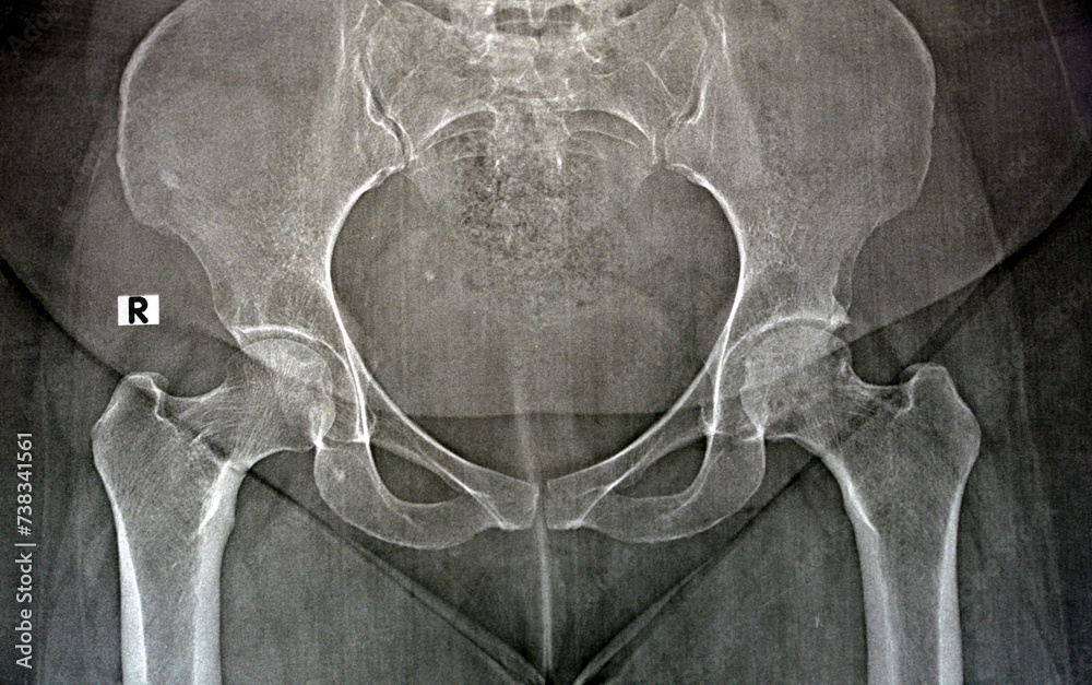 Plain X ray reveals bilateral Avascular necrosis (AVN) of the femoral ...