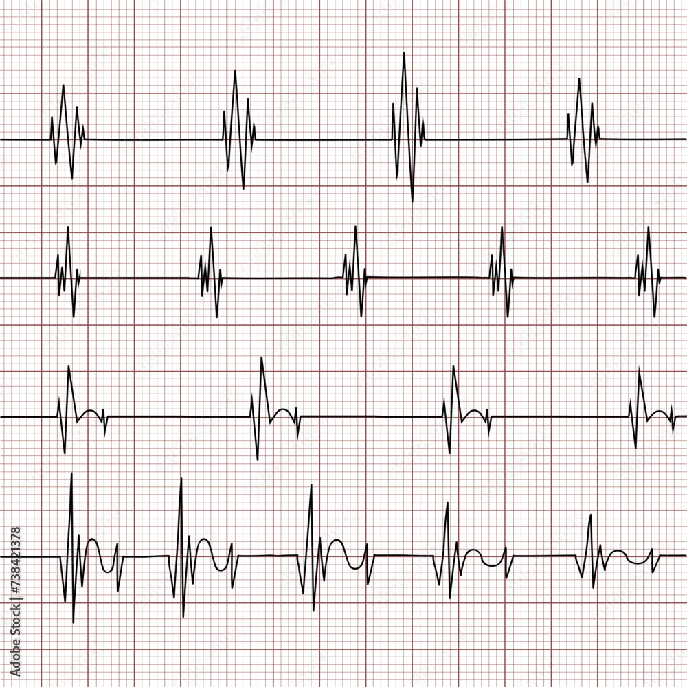 Multiple EKG (Electrocardiogram) graphs on a grid background. Various ...