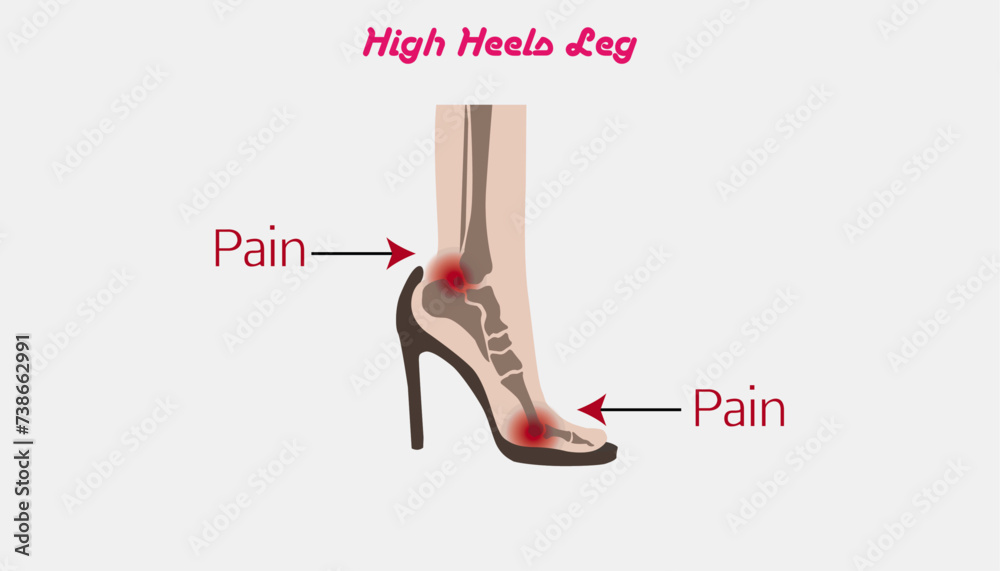 Vector de Stock high heels, Symptom pain on foot because wearing high ...