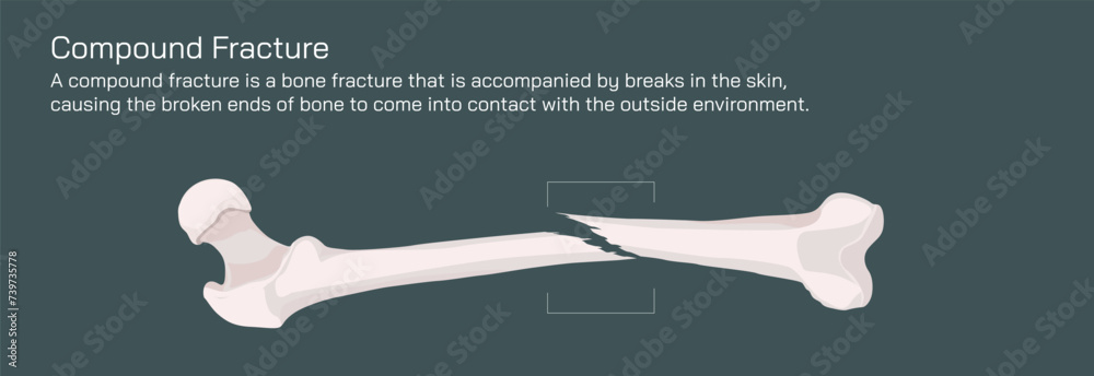 Types of bone fracture. Structure of a bone vector illustration. The ...
