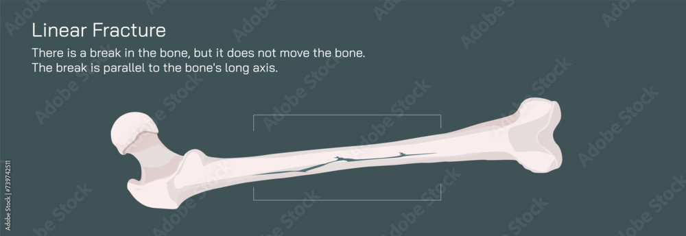 Types of bone fracture. Structure of a bone vector illustration. The ...