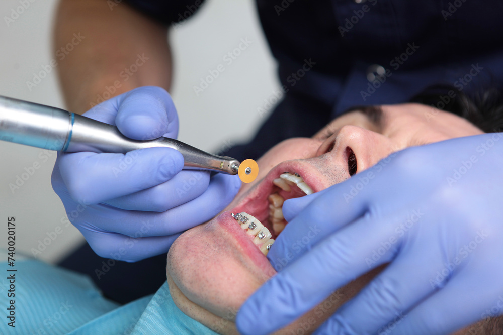 Alignment of the dentition with braces. Separation of the dentition ...