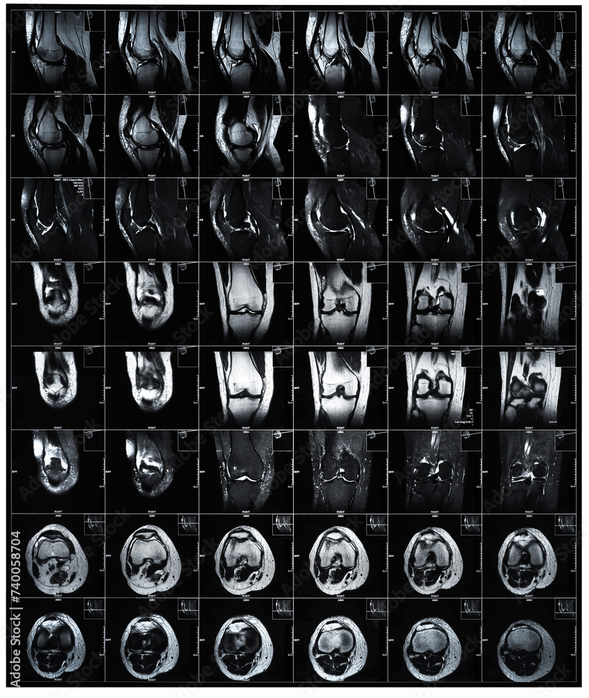 Xray MRI examination magnetic resonance images showing real fracture ...