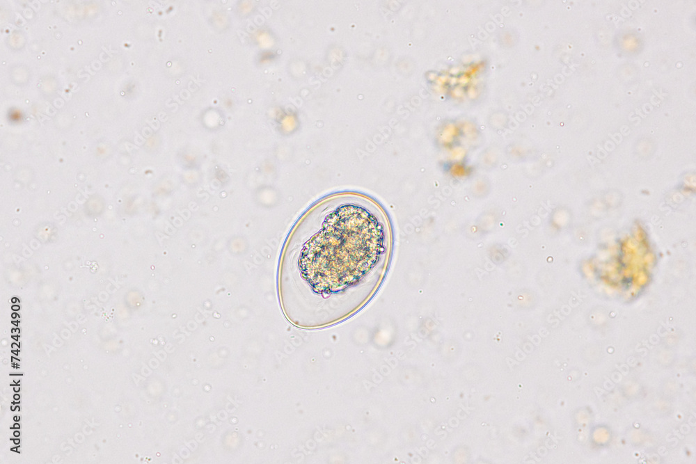 Finding Trichuris trichiura egg and Strongyloides egg in the feces ...