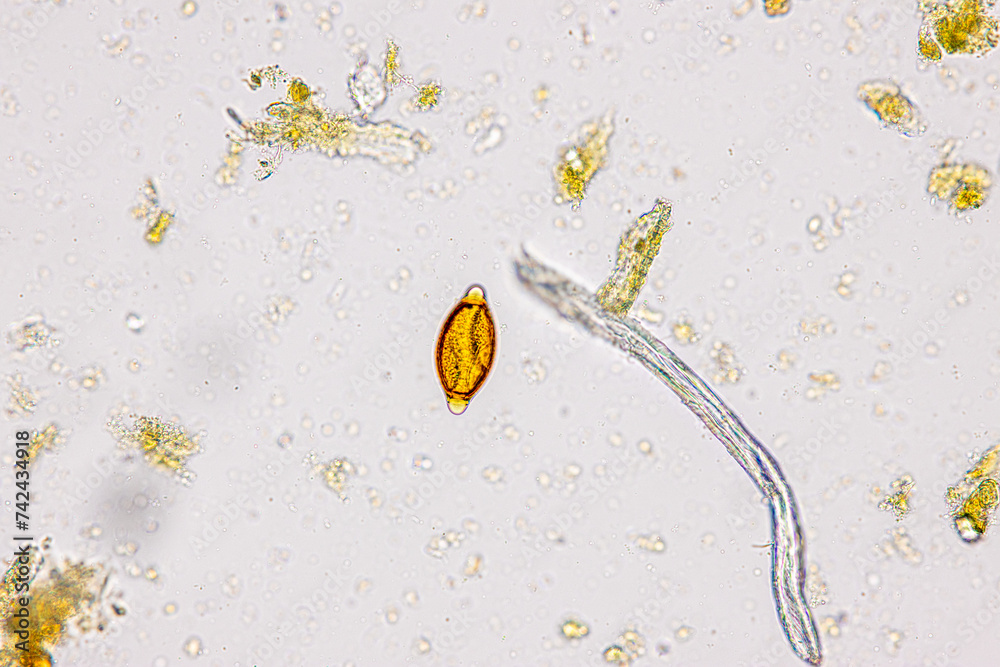 Finding Trichuris trichiura egg and Strongyloides egg in the feces ...
