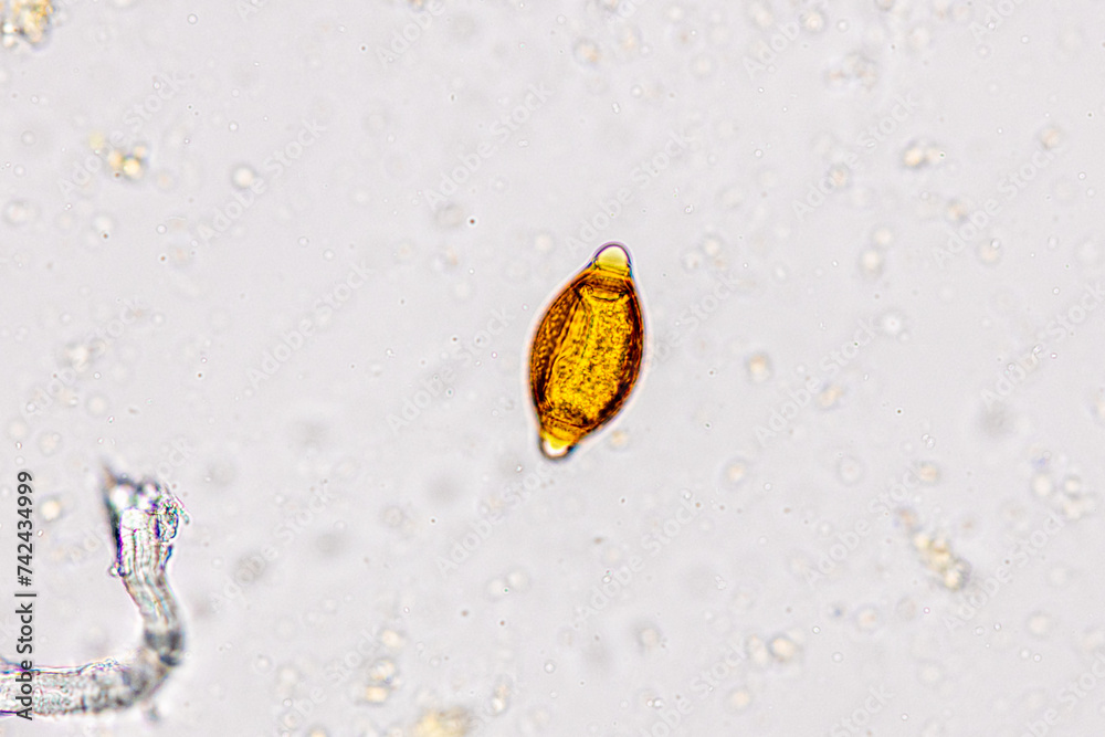 Finding Trichuris trichiura egg and Strongyloides egg in the feces ...