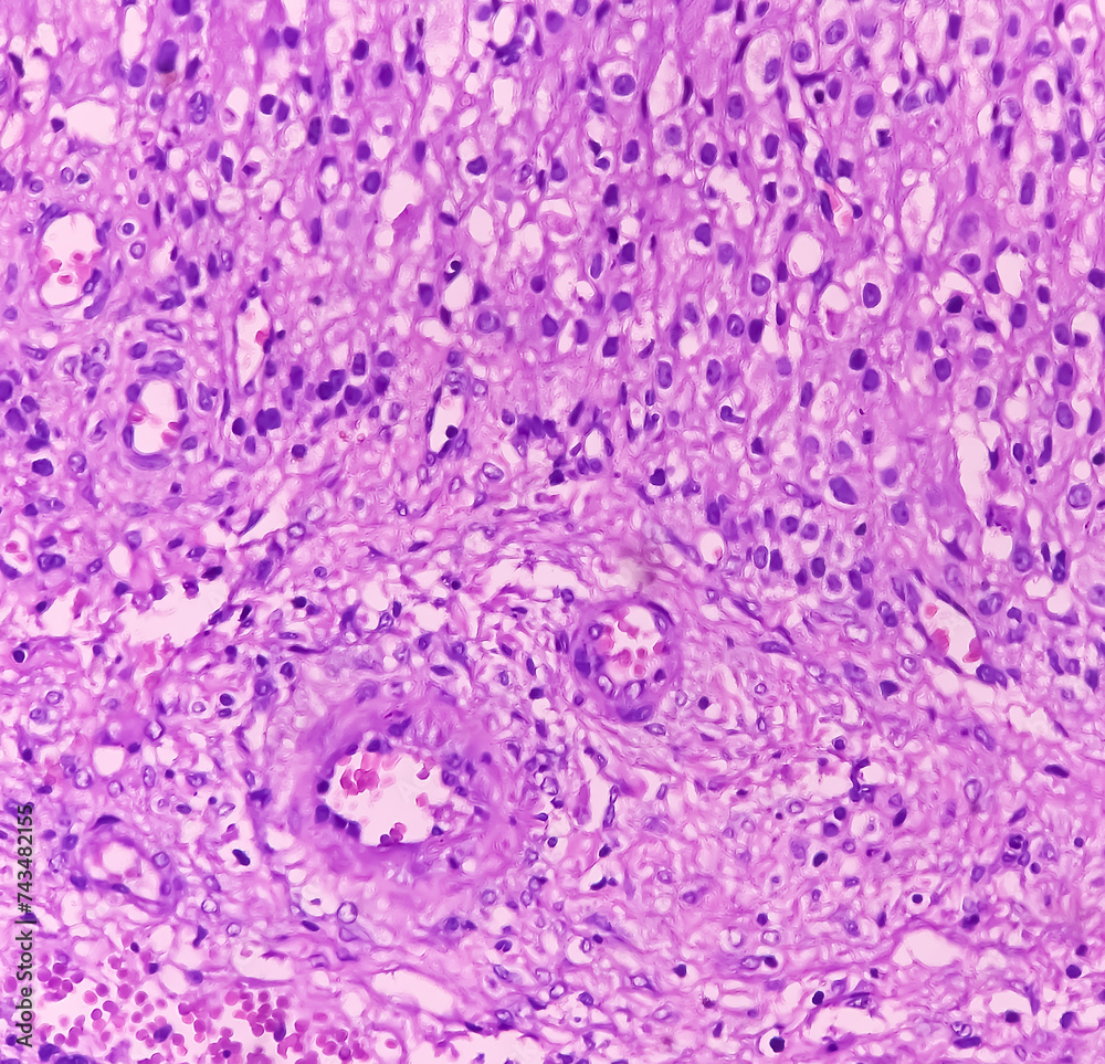 Photo Stock Ovarian cyst: Haemorrhagic cyst. Microscopic show ovarian ...