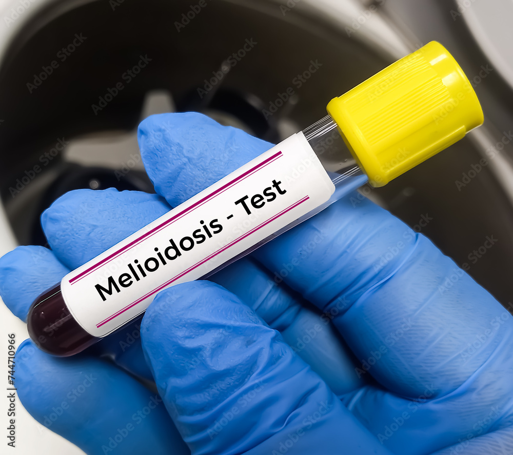 Blood sample for Melioidosis test, also called Whitmore's disease ...