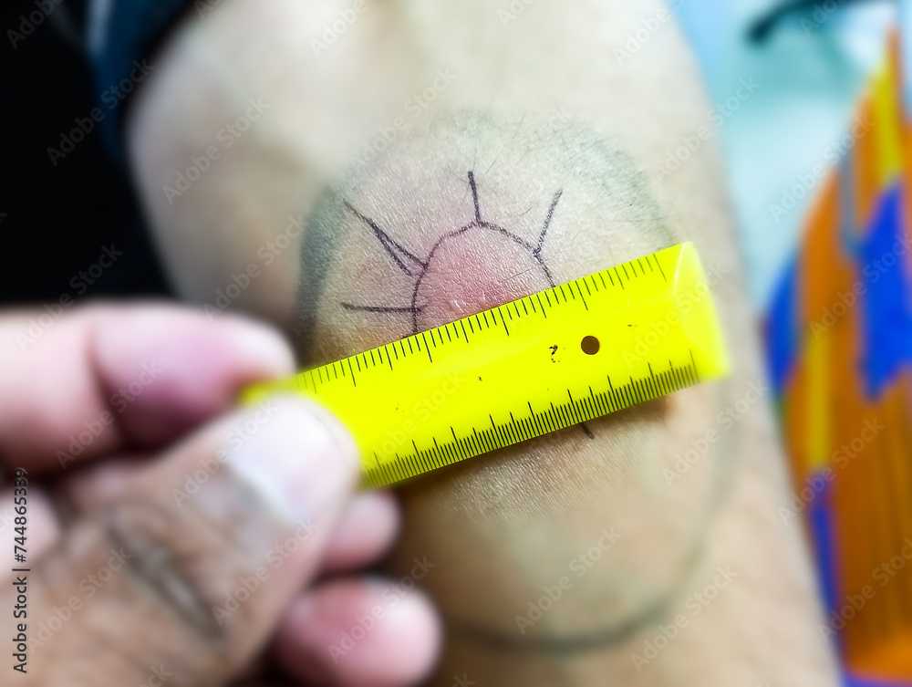 Mantoux tuberculin skin test (TST), Closeup view photography of patient ...