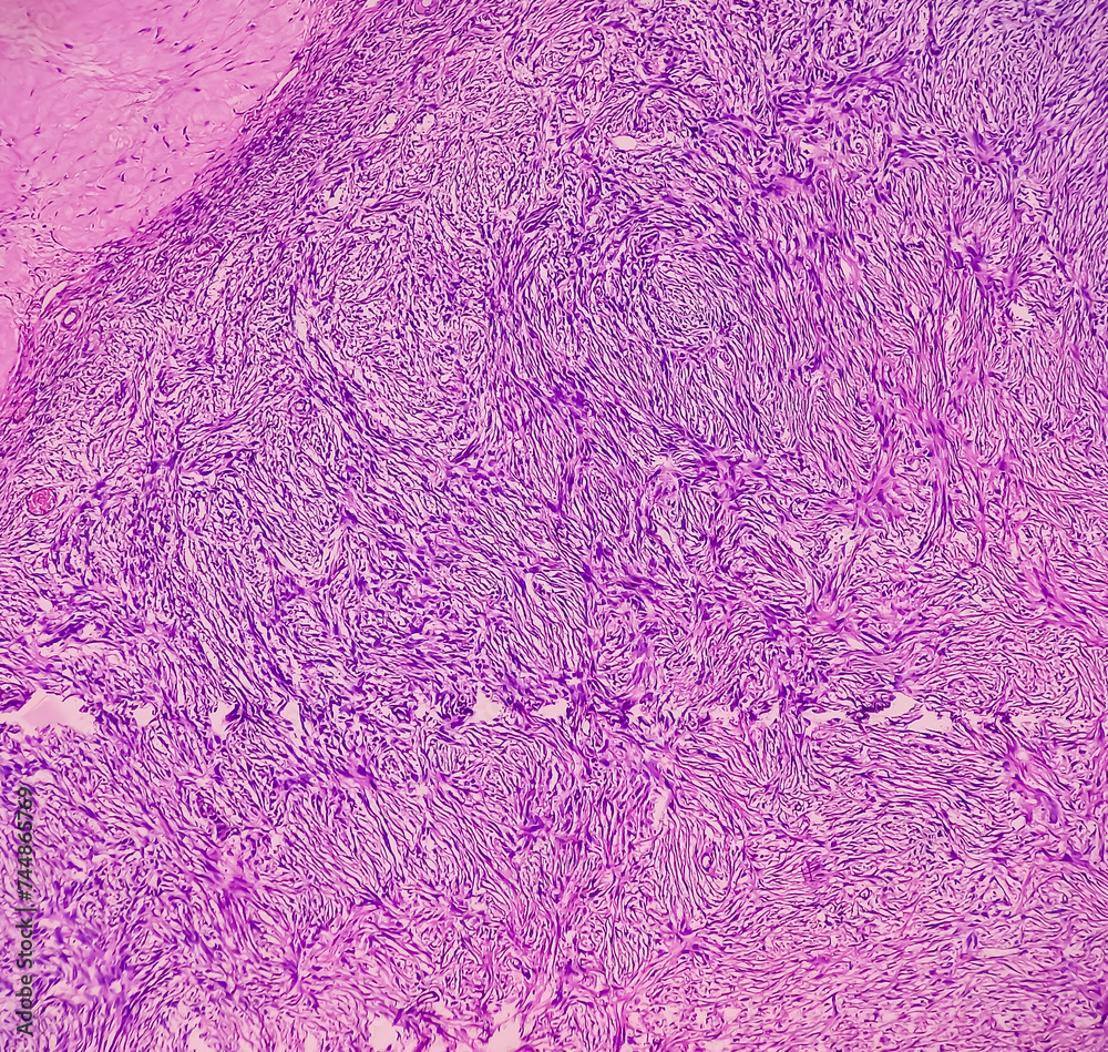 Uterus with adnexa (biopsy): Cervix show chronic inflamatory cells ...