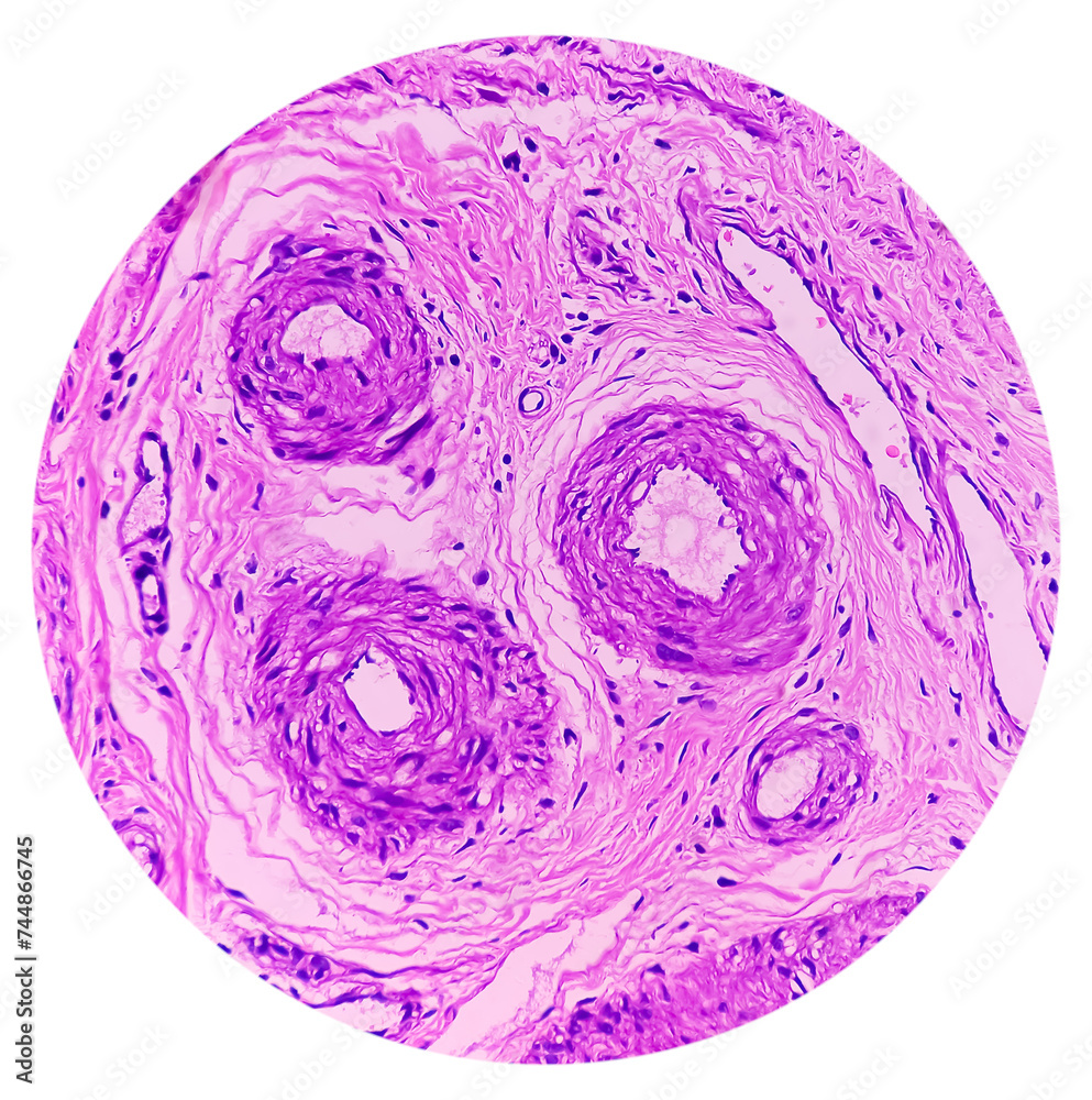 Uterus with adnexa (biopsy): Cervix show chronic inflamatory cells ...