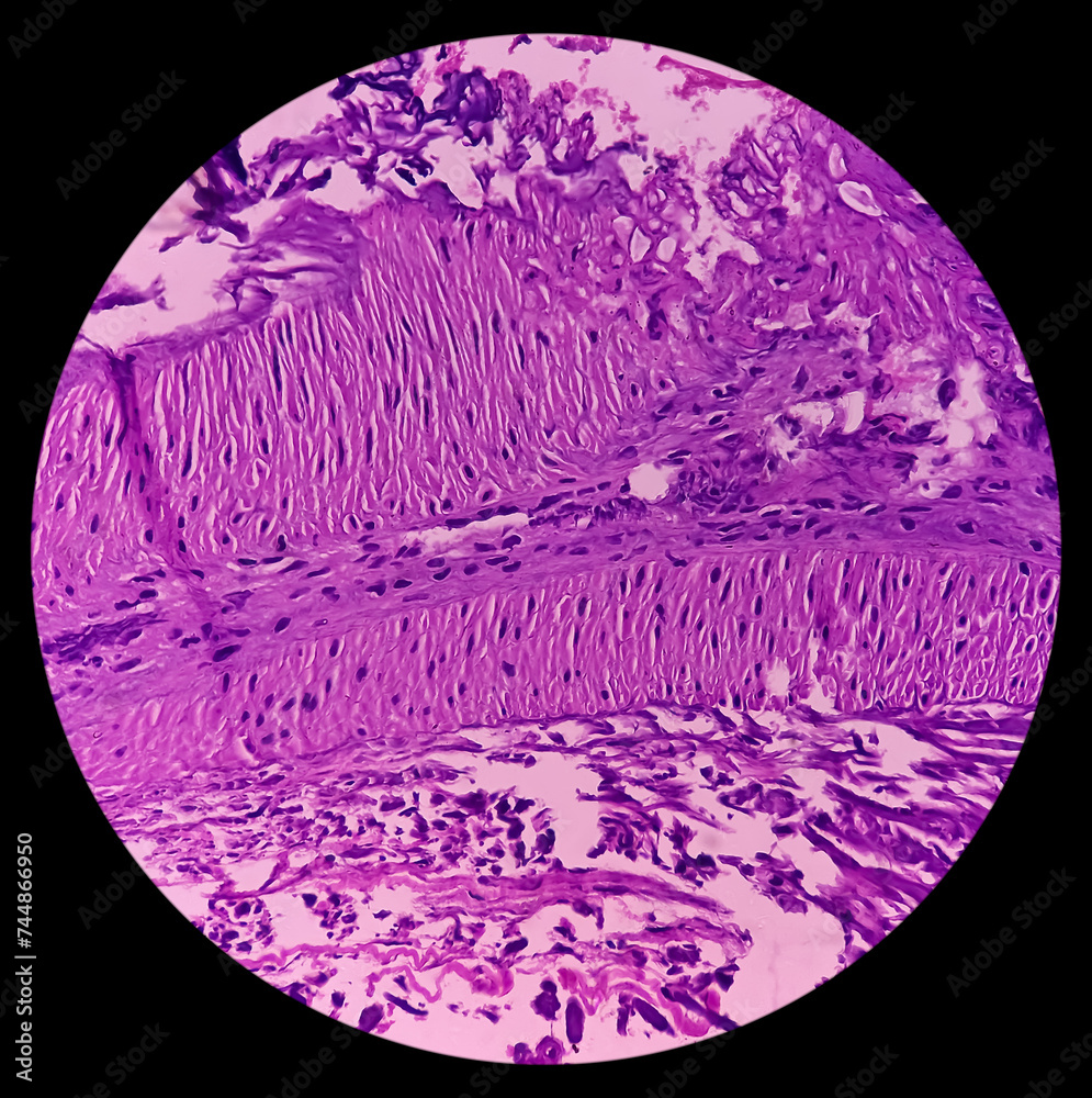 Photo Stock Swelling of middle finger (biopsy). Lobular Capillary ...