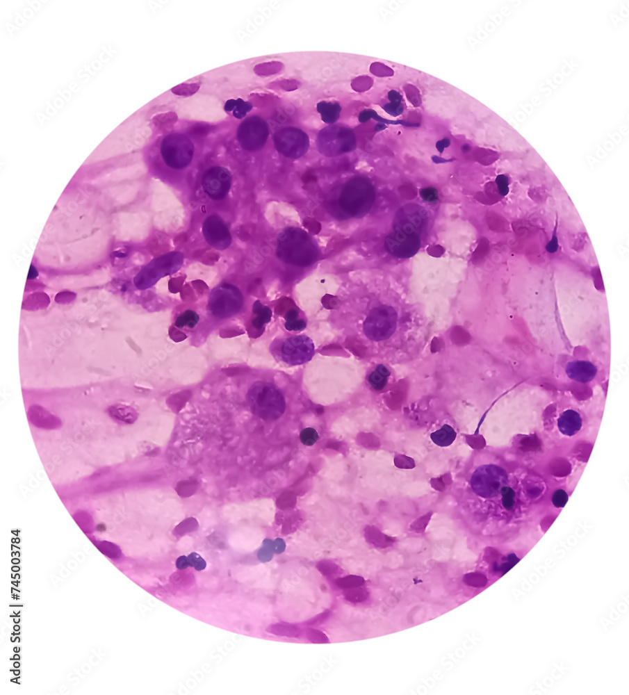 Foto de Stock FNA cytology of swelling of chest wall. Infected ...