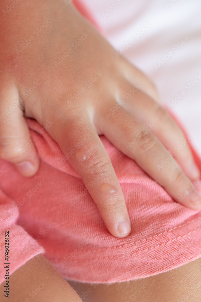 Foto de Stock coxsackievirus, Singapore flu, skin rashes, blisters ...