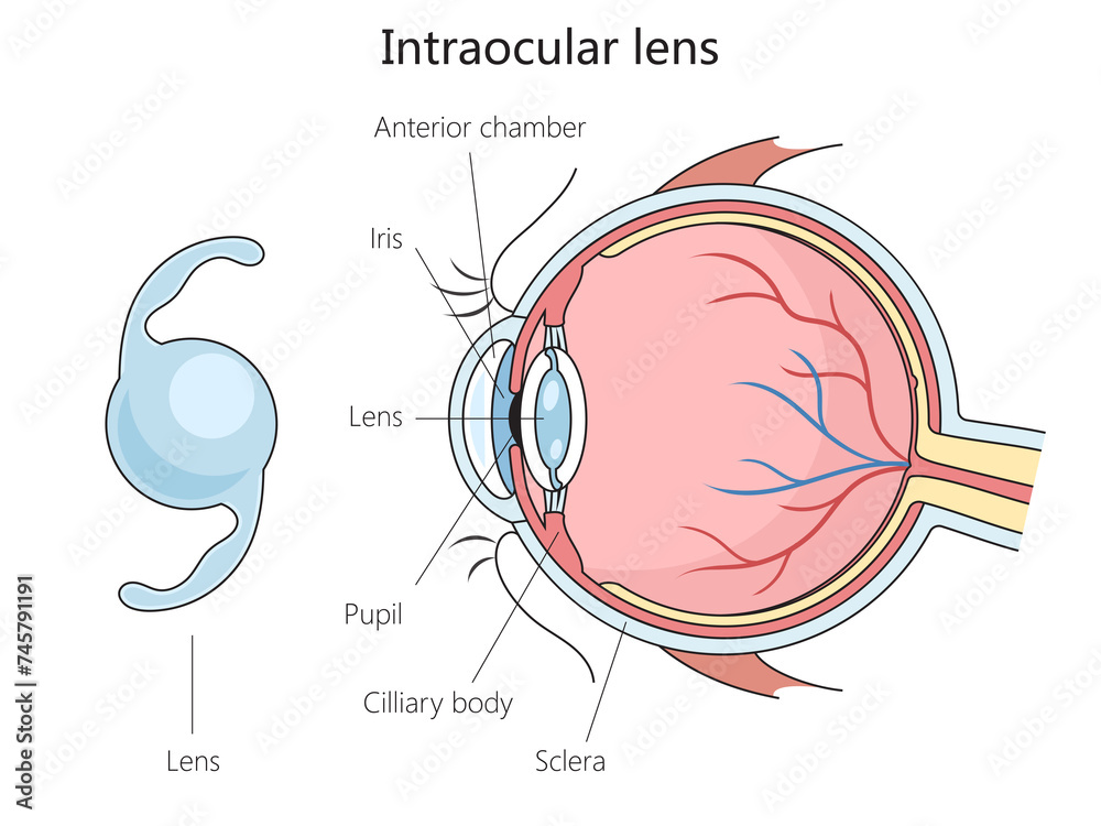 Intraocular lens structure diagram hand drawn schematic raster ...