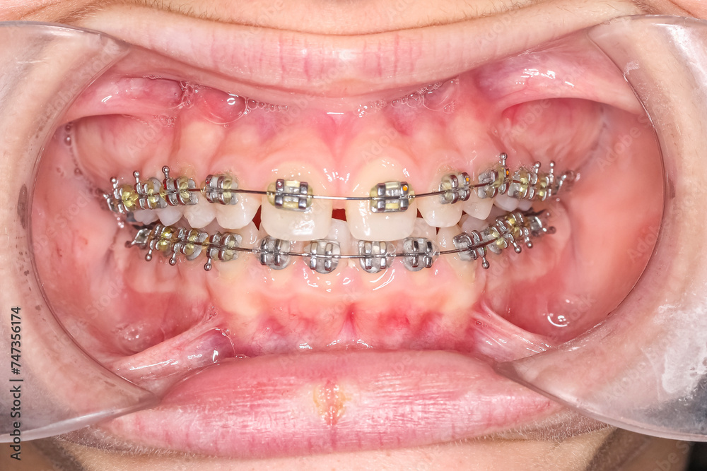 Frontal view of dental arches in biting gap toothed teeth patient ...