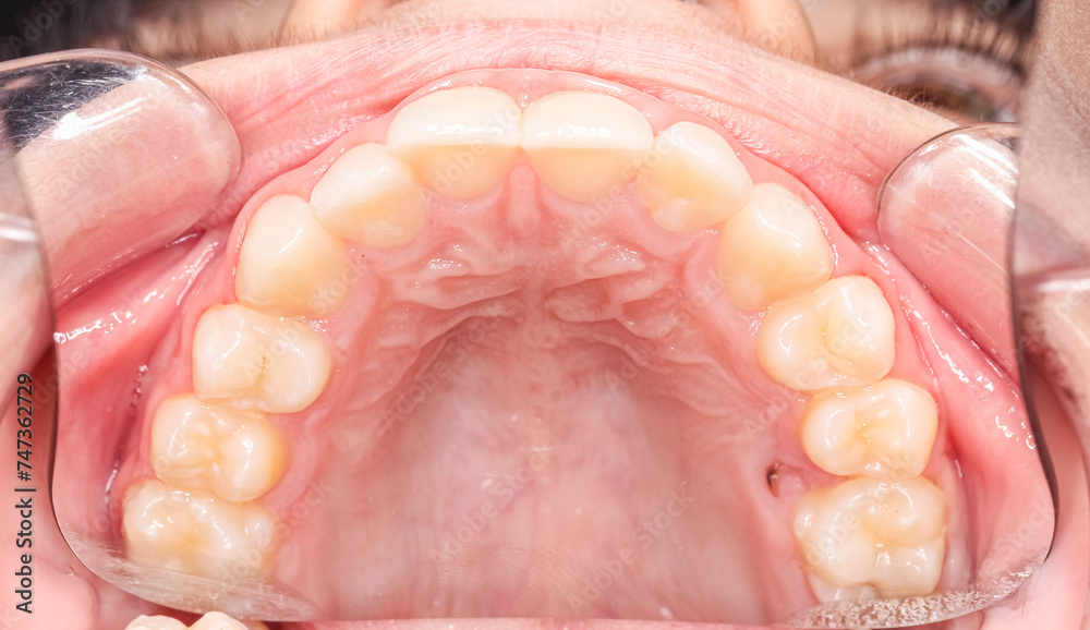 Upper maxillary arch, indirect occlusal view with buccal photography ...