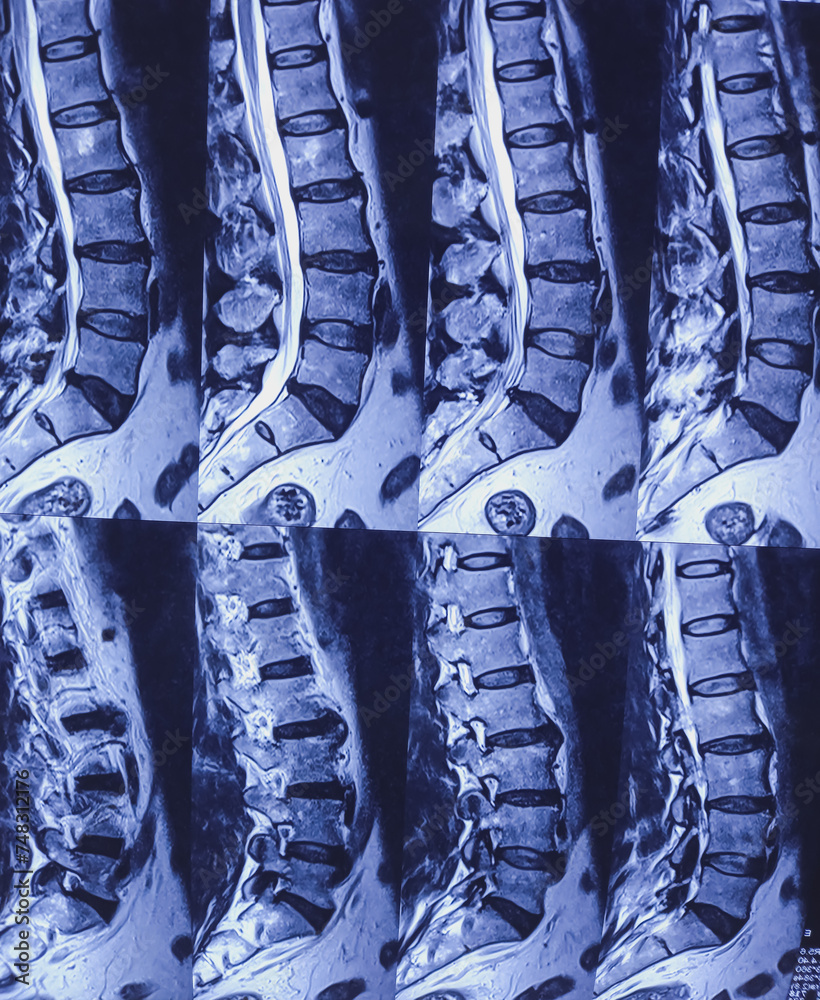 Photo Stock MRI (magnetic resonance imaging) of Lumbo sacral Spine. L4 ...