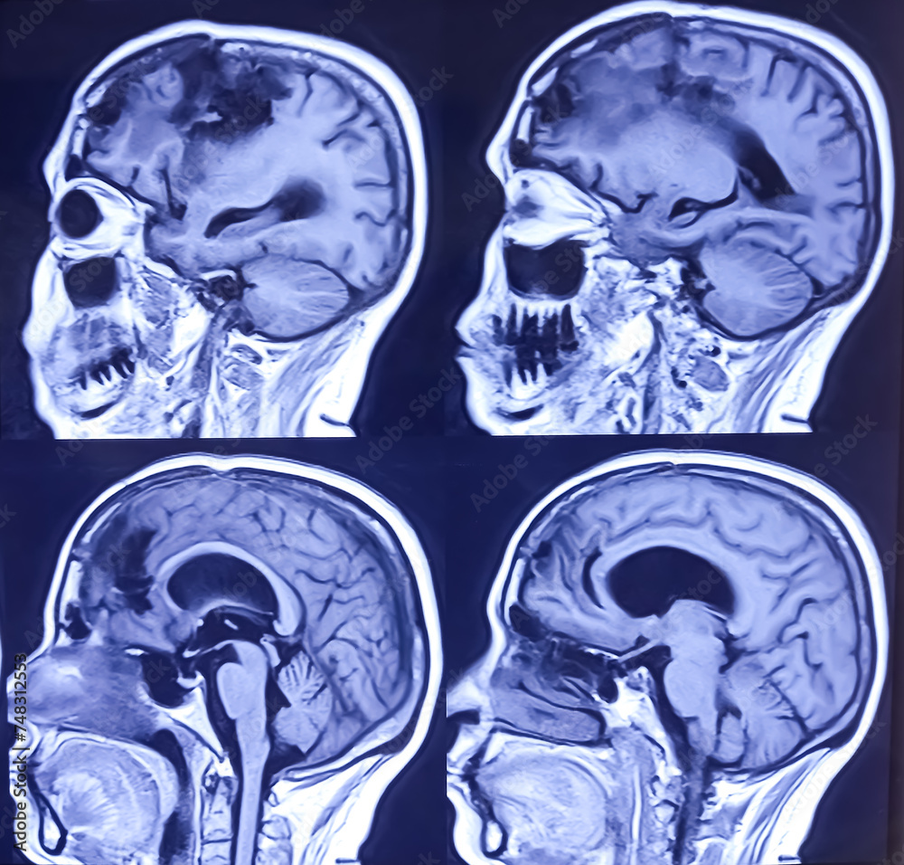 CT scan of PNS and Head: Hypertrophied both inferior nasal turbinates ...