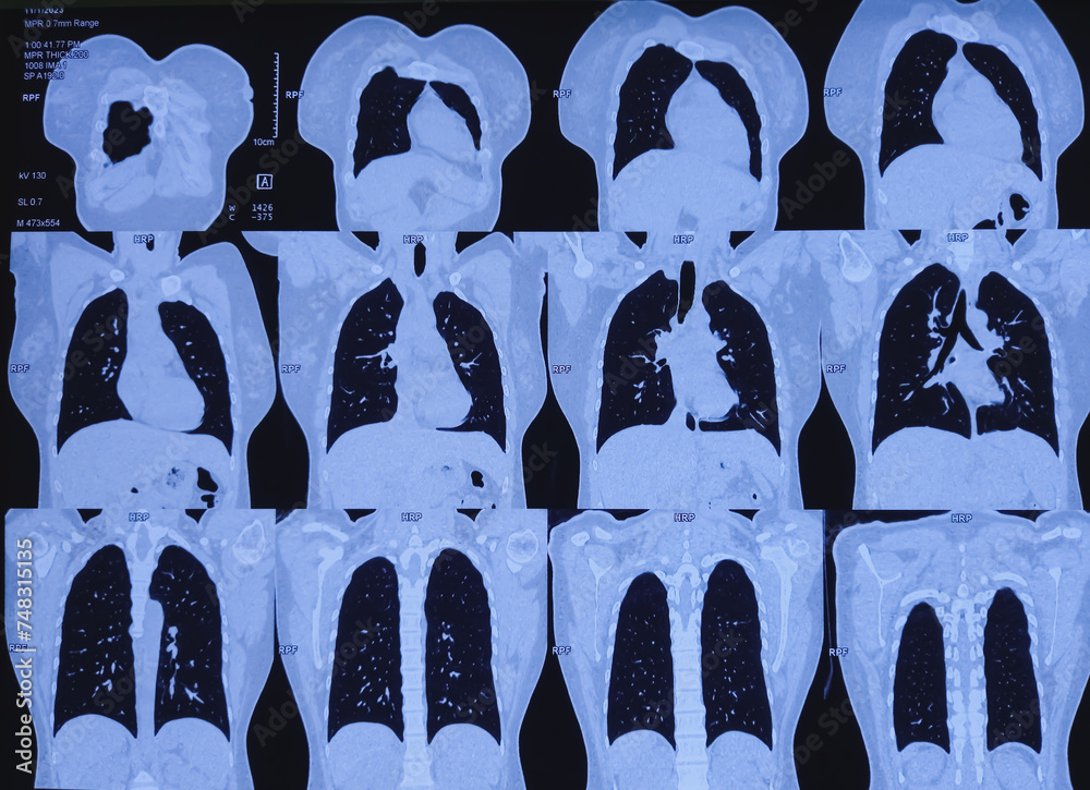 Multi slice HRCT scan of chest showing normal study, normal appearance ...