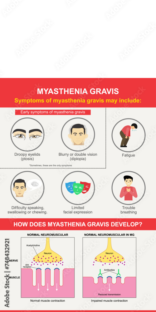 Myasthenia gravis infographic illustration of signs and symptoms Stock ...