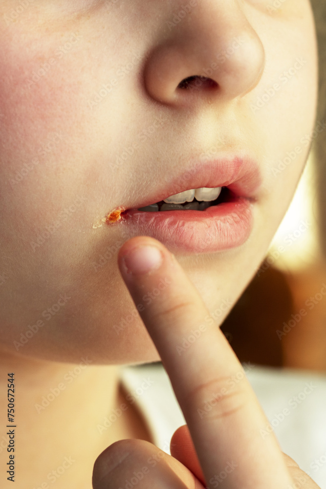 herpes, zoster, lips. corner mouth Stock Photo | Adobe Stock