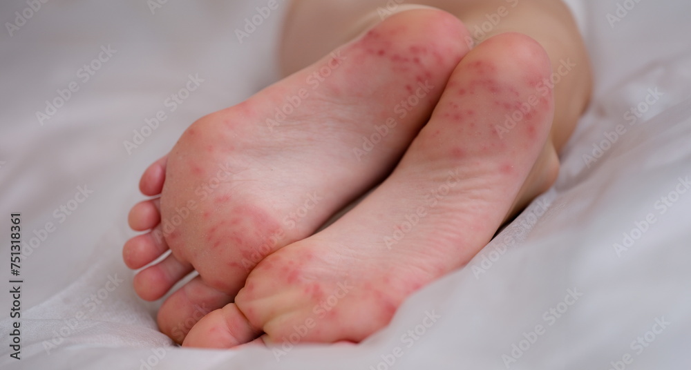 Painful rash red spots blisters on child leg. Children skin with eczema ...