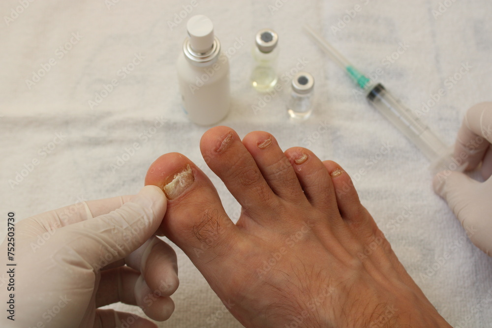 dermatologist examining patient with toenail fungus. A doctor examines ...