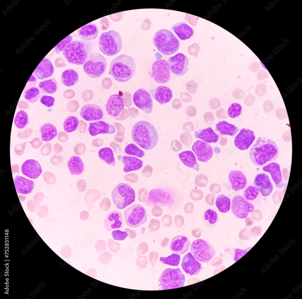 Blood cancer. Photomicrograph of Acute Myeloblastic Leukemia or AML, a ...