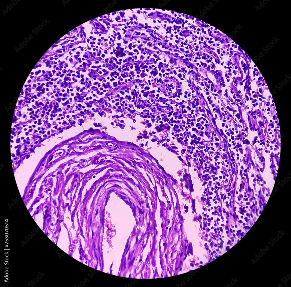 Microscopic image of above knee amputation. Section show fibro ...