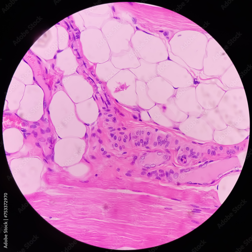 Microscopic image of above knee amputation. Section show fibro ...