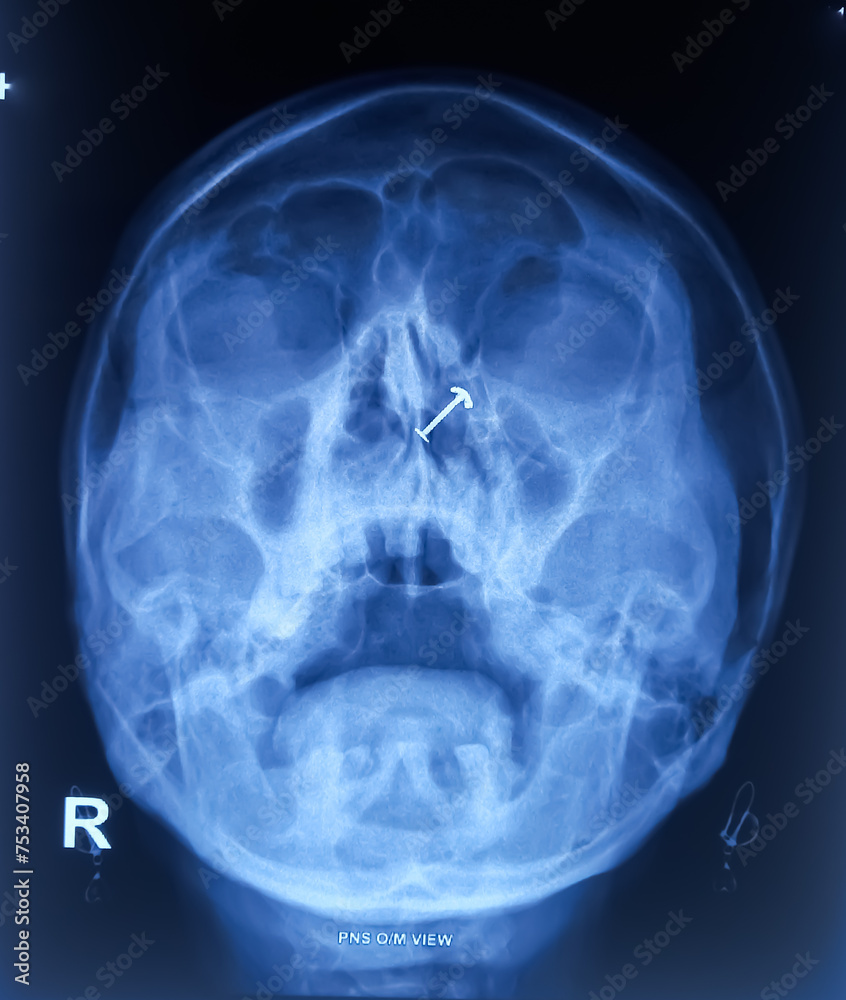 Foto de Stock PNS X-ray OM view film, bilateral maxillary sinusitis ...