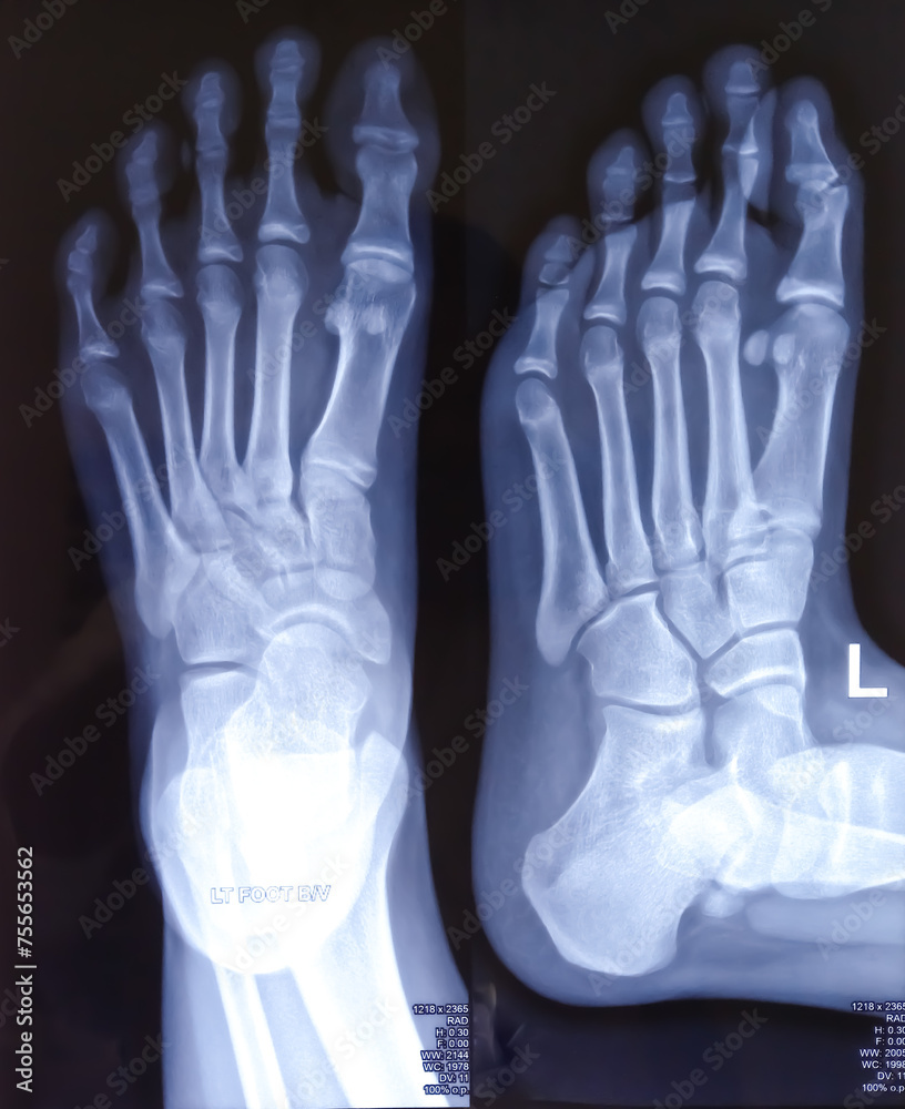 X-ray or radiograph of an ankle showing anatomy of bones and joint of ...
