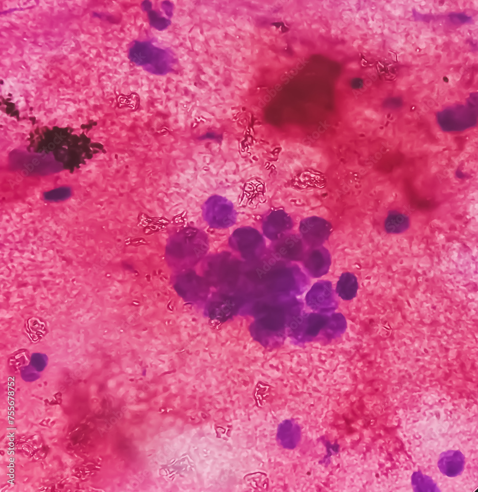 CT Guaided FNA cytology from left hilar mass. Microscopic show atypical ...