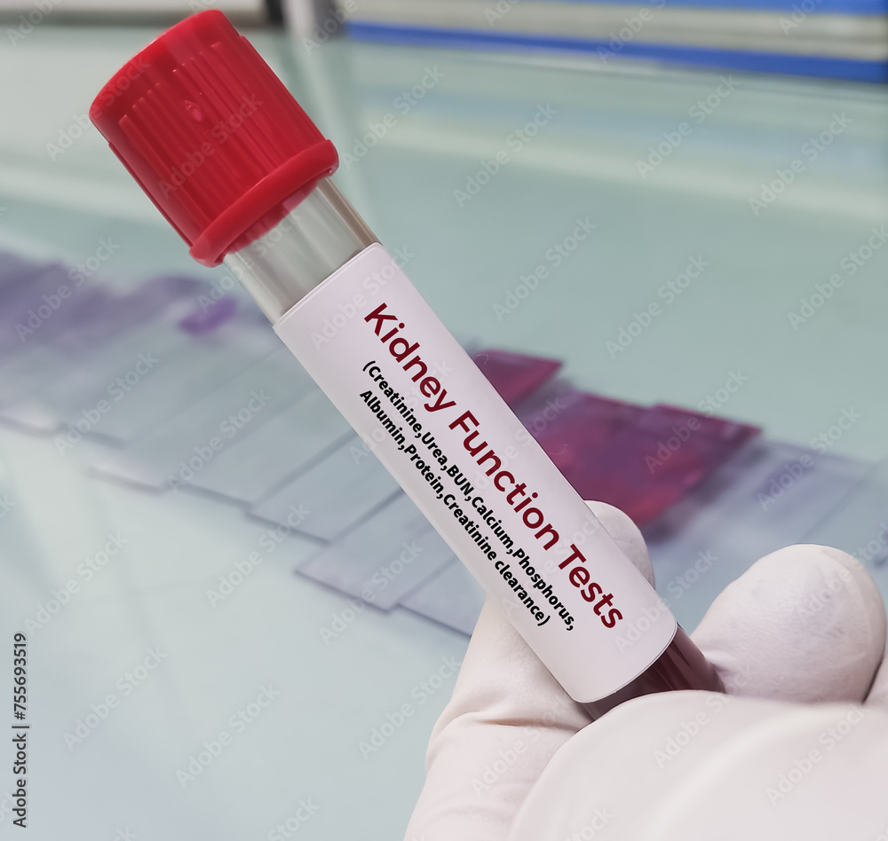 Blood sample for Renal Function test (Creatinine, BUN, eGFR, albumin ...