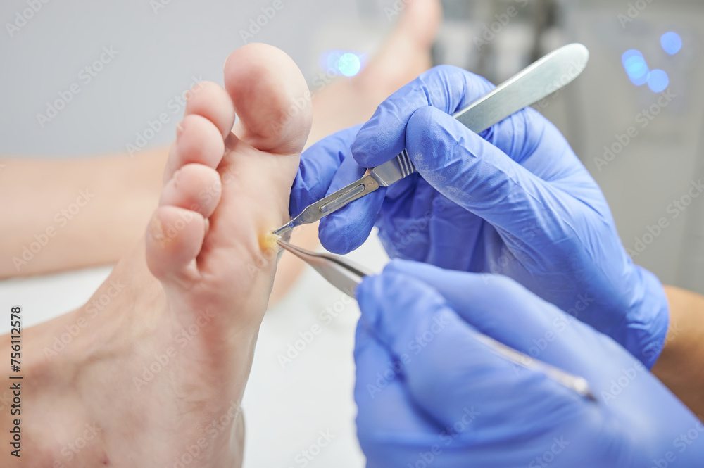 Podiatrist removing a foot callous in his podiatry clinic using ...