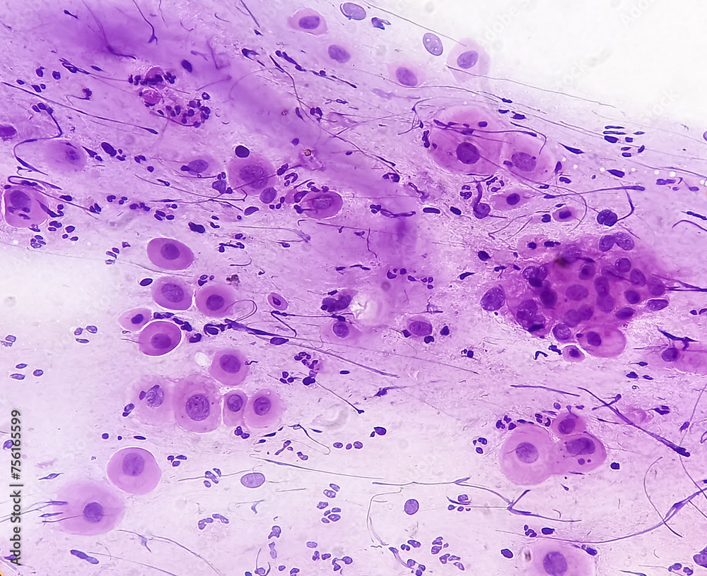Light micrograph of a vaginal smear showing adenocarcinoma cells ...