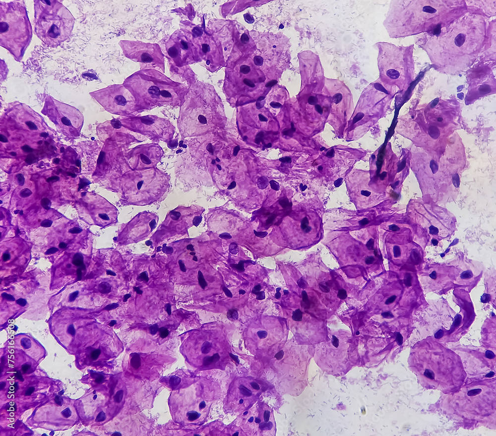 Light micrograph of a vaginal smear showing adenocarcinoma cells ...